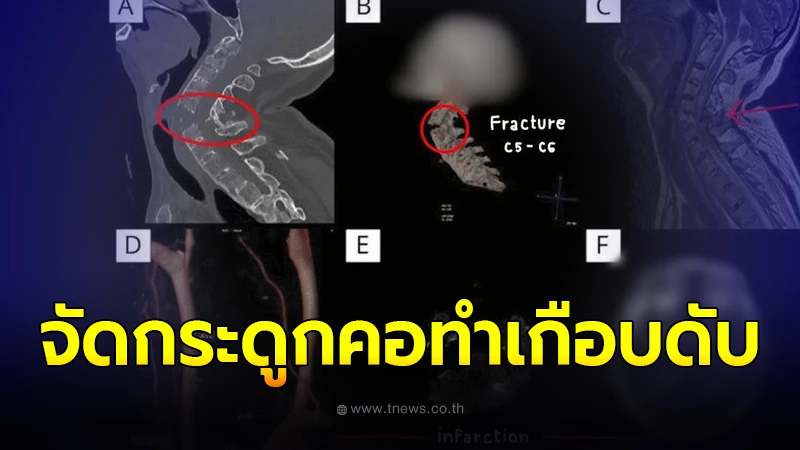 สาวใหญ่ ไปจัดกระดูกคอ กลับมาปวดหนักกว่าเดิม หาหมอทำซีทีสแกน ยิ่งตกใจ